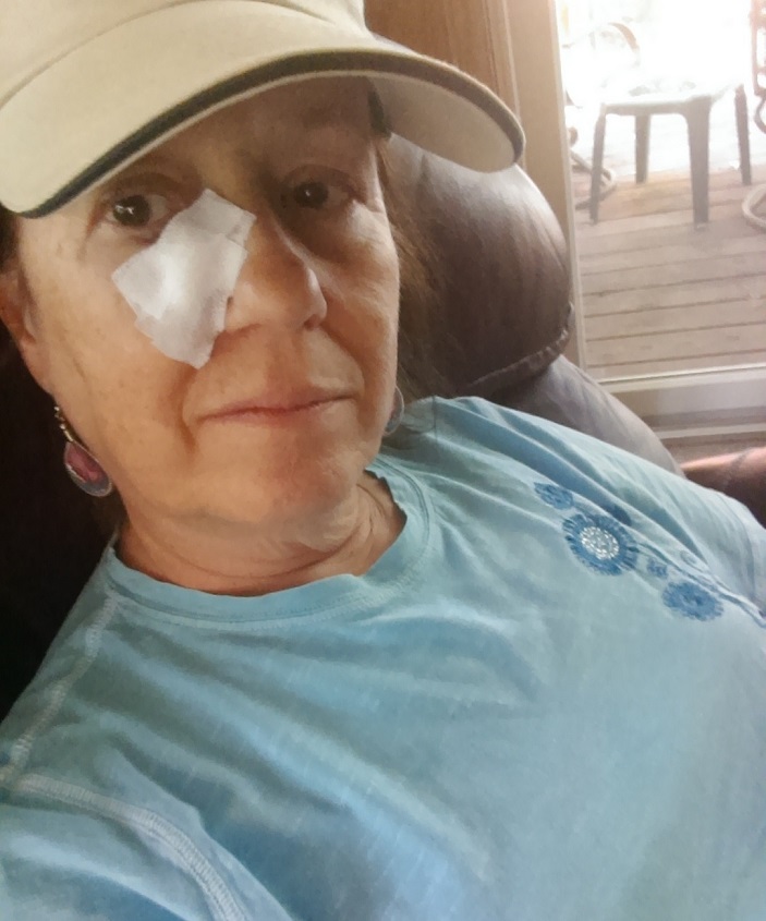 Post skin cancer surgery – Nancy's Point